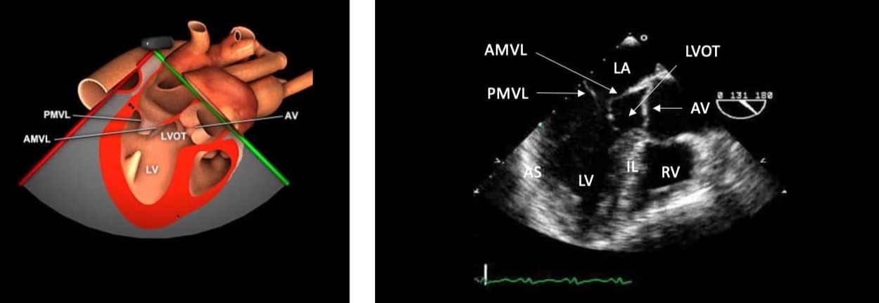 POCUS Spotlight: Resuscitative Perioperative Transesophageal ...