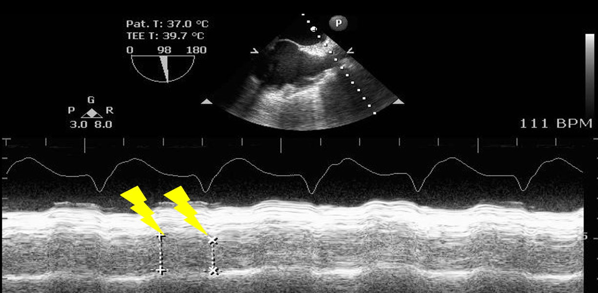 POCUS Spotlight: Resuscitative Perioperative Transesophageal ...